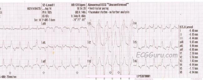 Fusion beats | ECG Guru - Instructor Resources